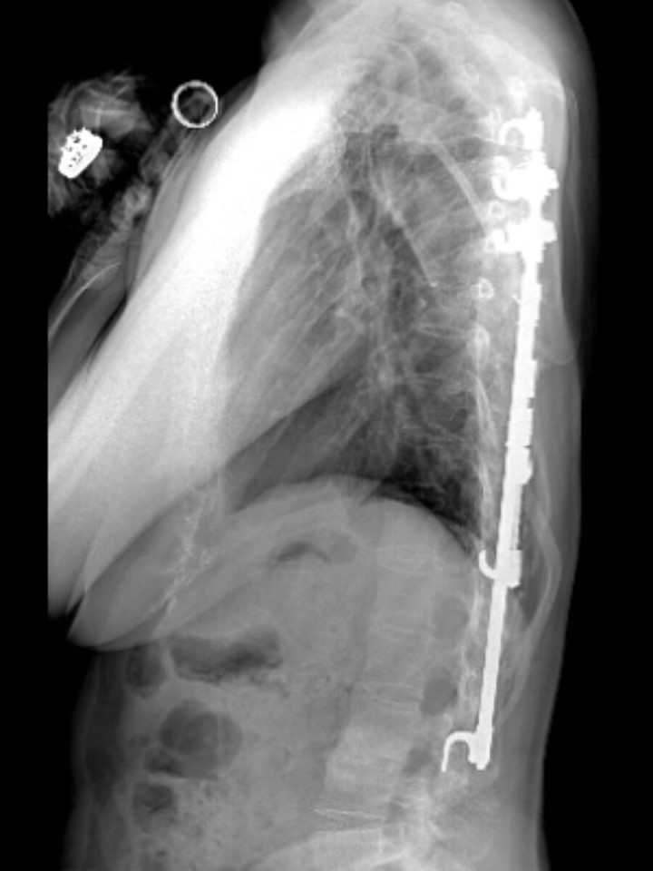 Flatback Syndrome after Harrington Rod