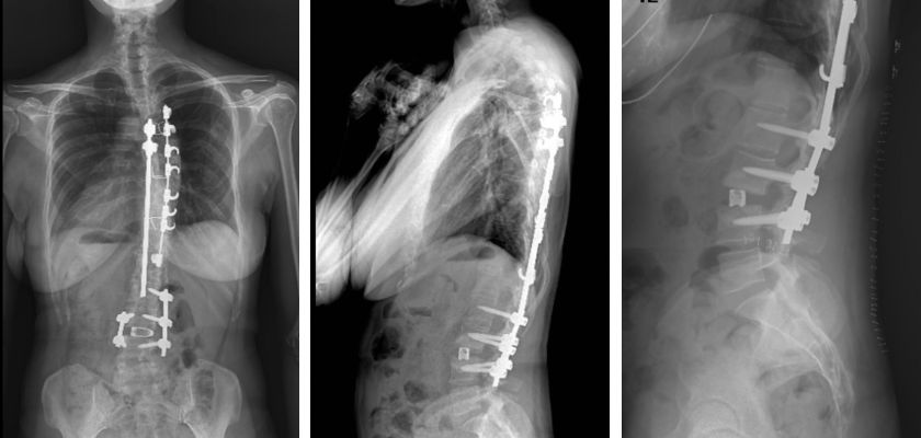 Flatback Syndrome after Harrington Rod